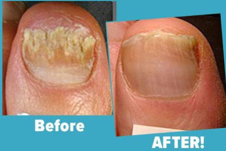 Fungal Nail Infections: What They Are and How to Treat Them.